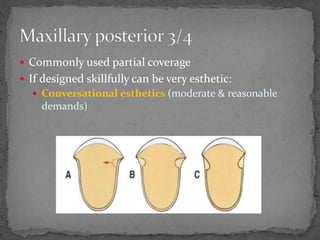 preparation for partial coverage crowns | PPTX