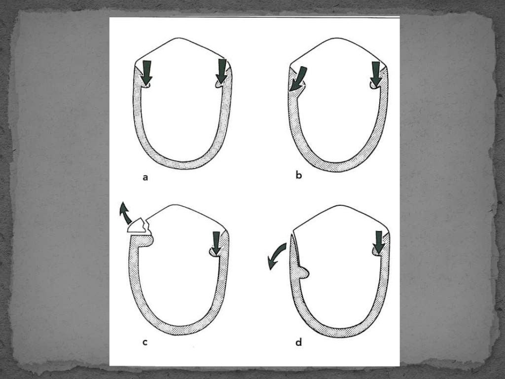 preparation for partial coverage crowns