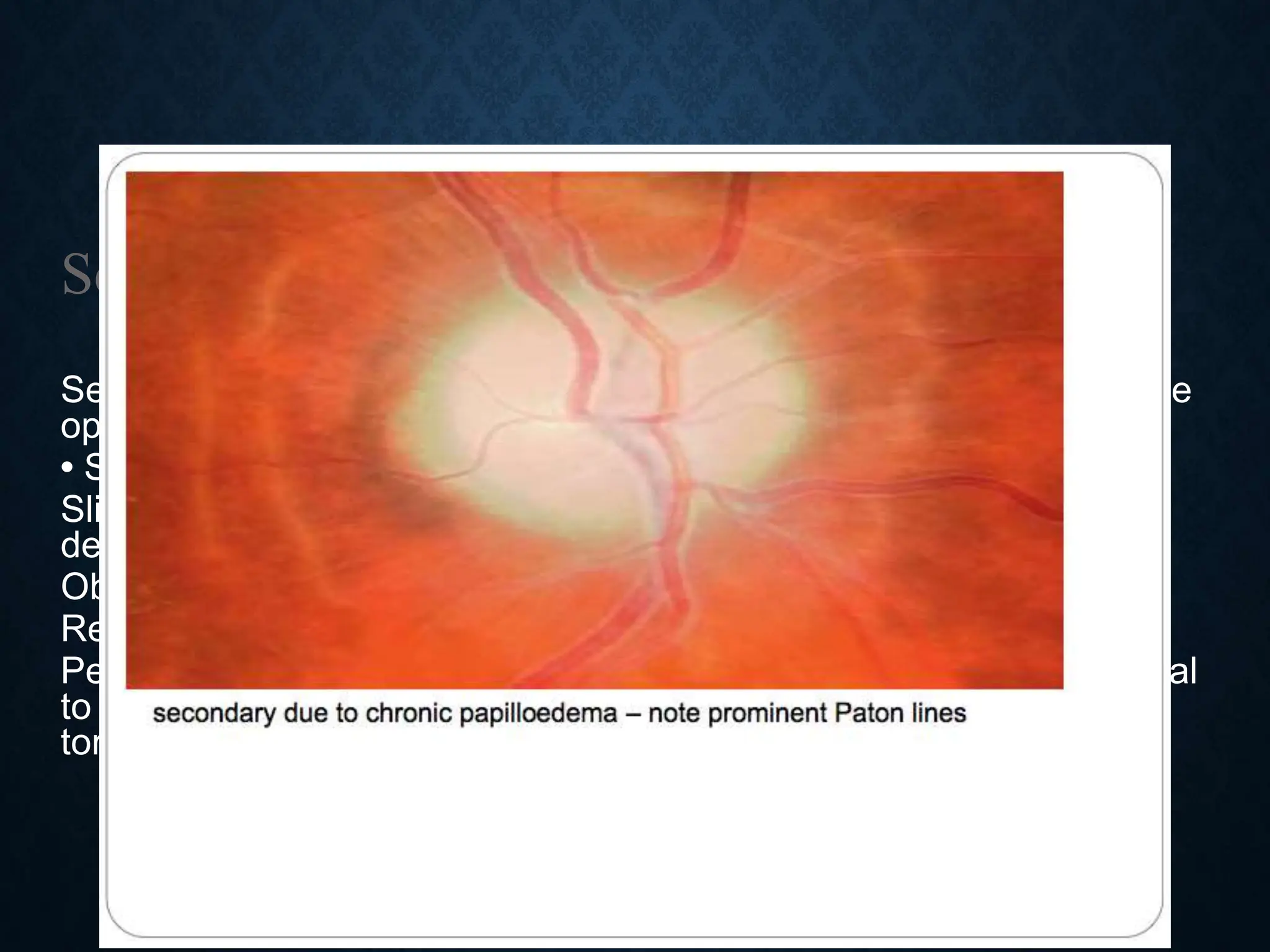 papilitis.pptx