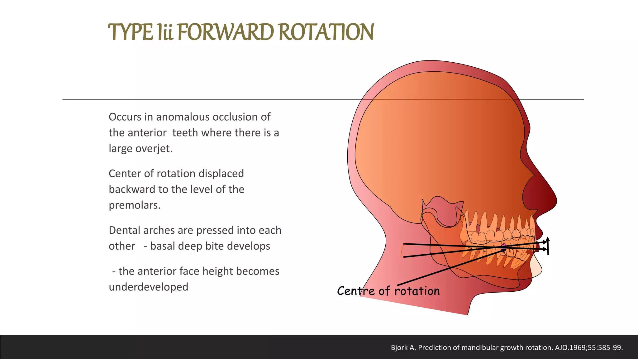Bjork’s Concept of Jaw Rotation | PPTX