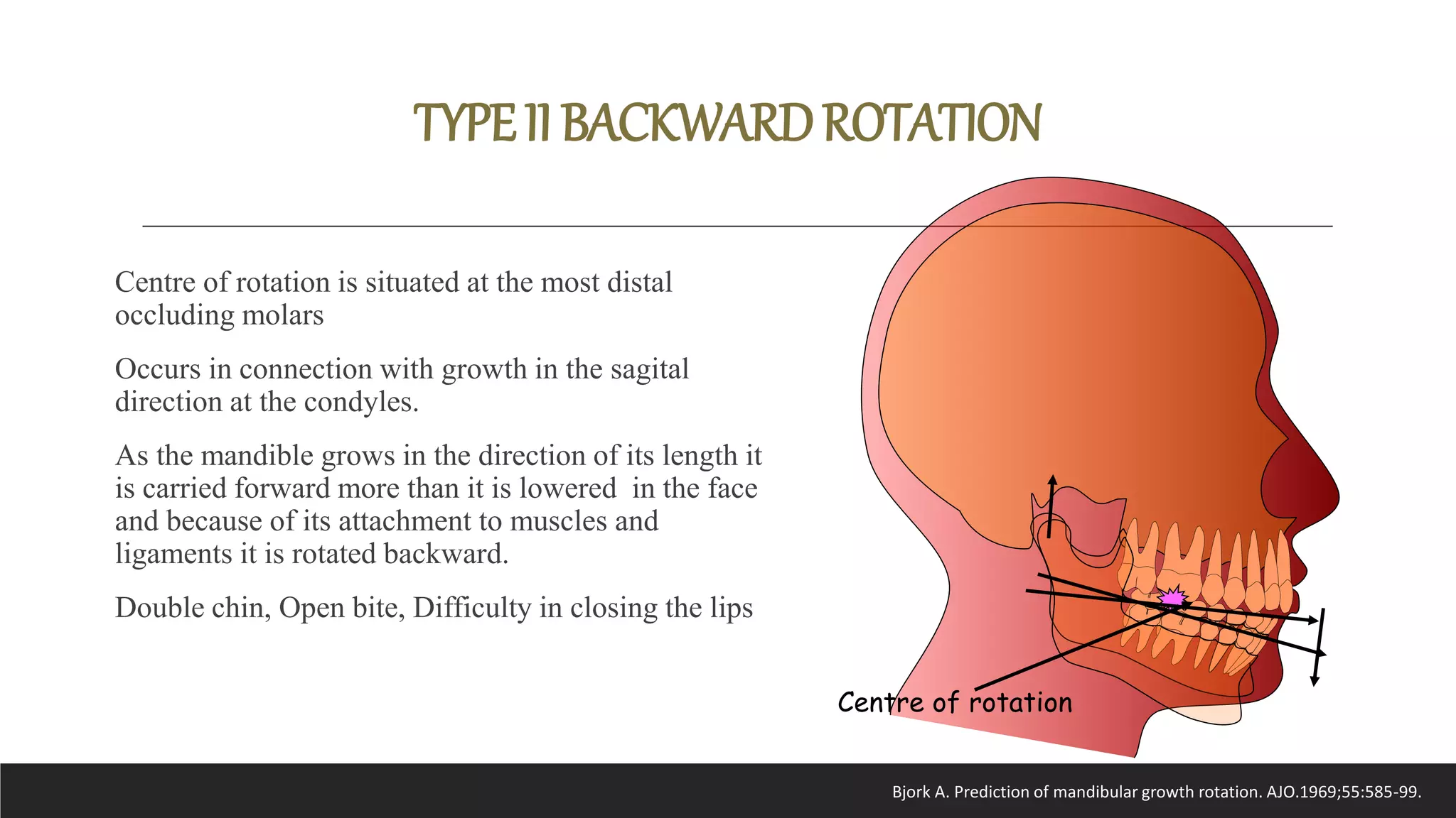 Bjork’s Concept of Jaw Rotation | PPTX