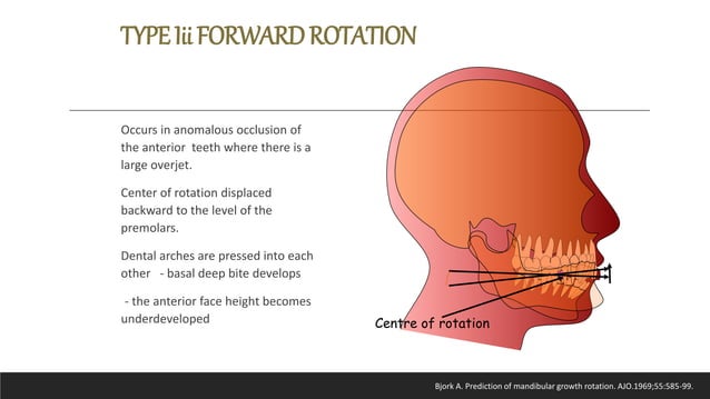 Bjork’s Concept of Jaw Rotation | PPTX | Bone and Joint Conditions ...
