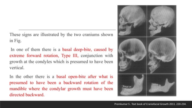 Bjork’s Concept of Jaw Rotation | PPTX | Bone and Joint Conditions ...