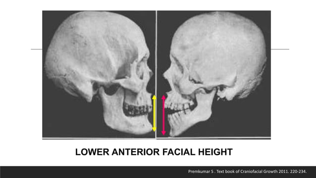 Bjork’s Concept of Jaw Rotation | PPTX | Bone and Joint Conditions ...