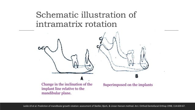 Bjork’s Concept of Jaw Rotation | PPTX | Bone and Joint Conditions ...