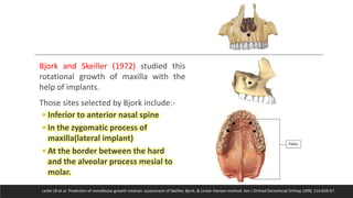Bjork’s Concept of Jaw Rotation | PPT