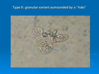 Bk Polyoma Virus | PPT