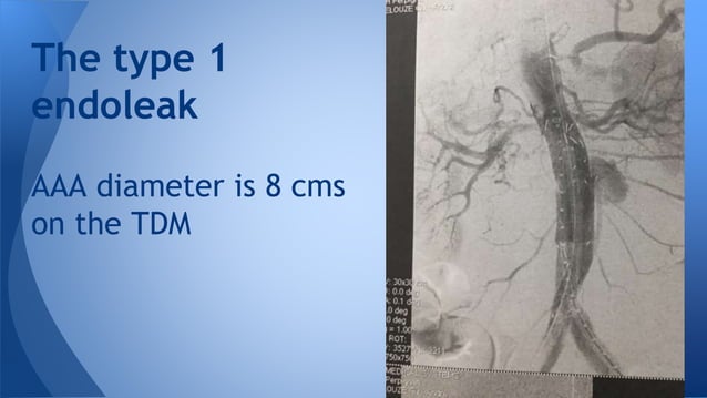 Emergency treatment for type 1 endoleak after evar | PPTX