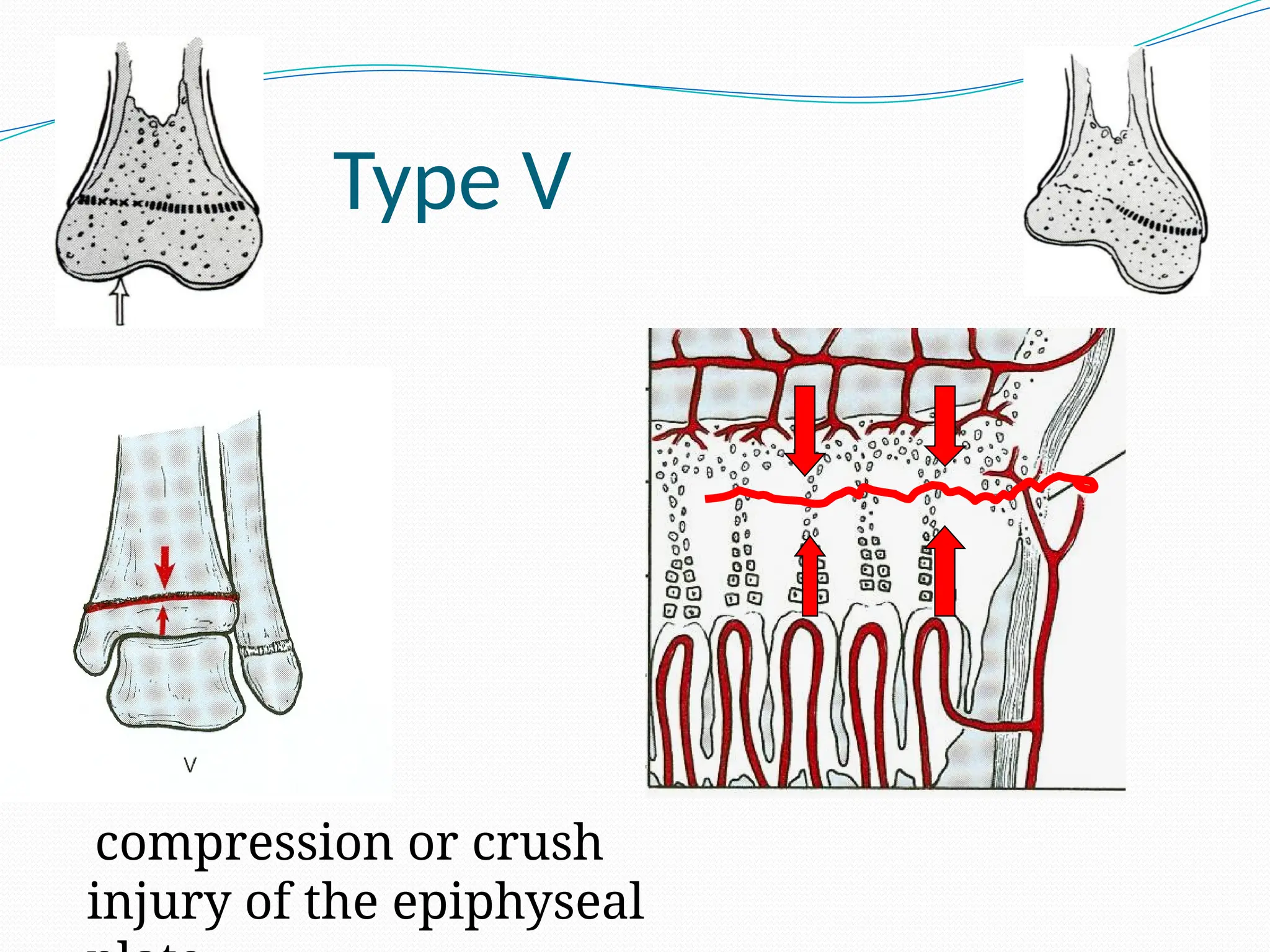 BKK EPIPHYSEAL INJURIES IN CHILDREN- Copy.pptx
