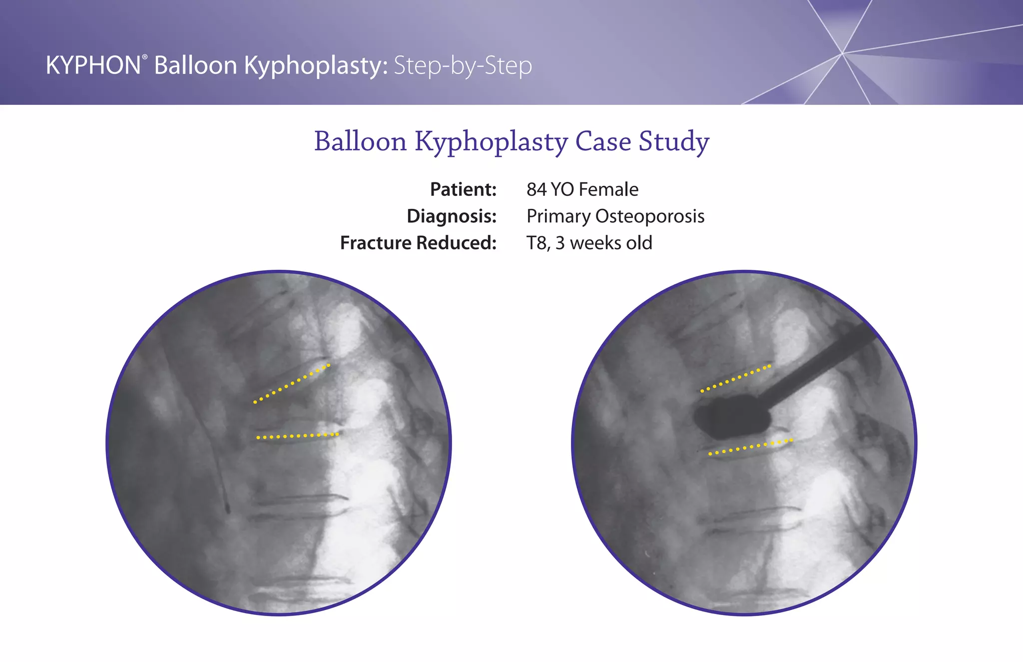 Balloon Kyphoplasty Step By Step Procedure Guide | PDF