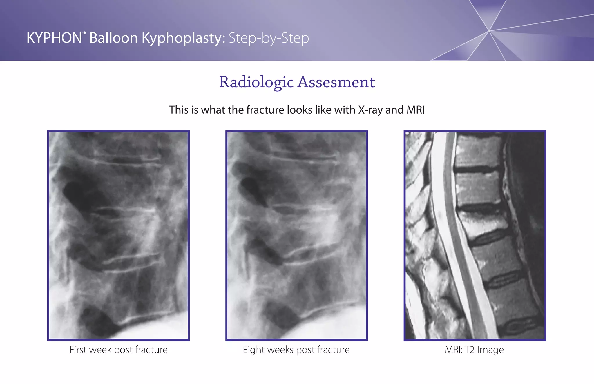 Balloon Kyphoplasty Step By Step Procedure Guide | PDF