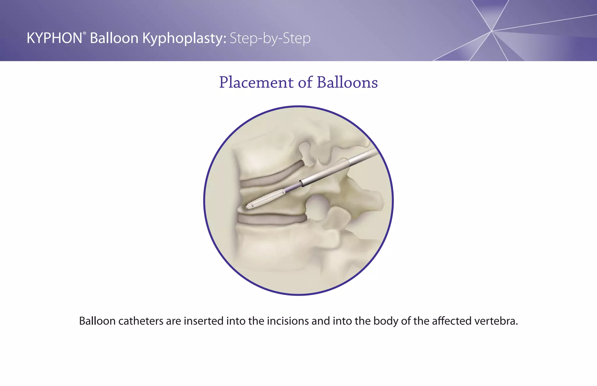 Balloon Kyphoplasty Step By Step Procedure Guide | PDF