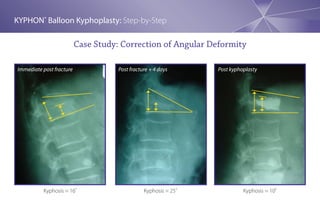 Balloon Kyphoplasty Step By Step Procedure Guide | PDF