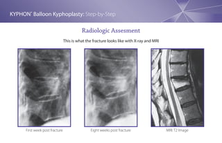 Balloon Kyphoplasty Step By Step Procedure Guide | PDF