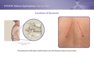 Balloon Kyphoplasty Step By Step Procedure Guide | PDF