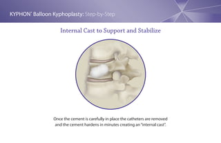 Balloon Kyphoplasty Step By Step Procedure Guide | PDF