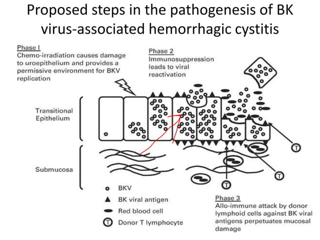 BK Virus infection in HSCT | PPTX