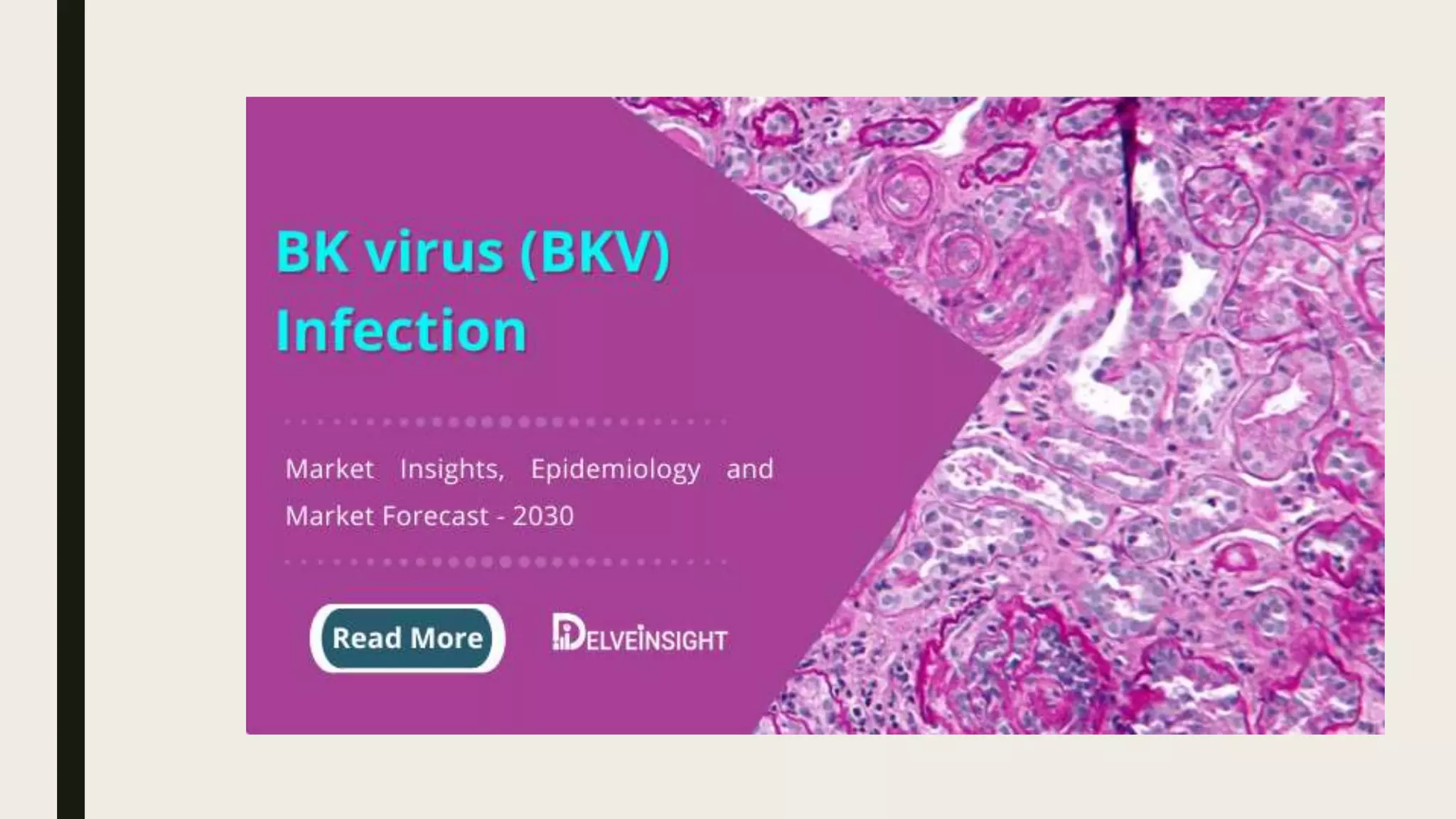 Bk virus (BKV) Infection Market | PPT | Free Download