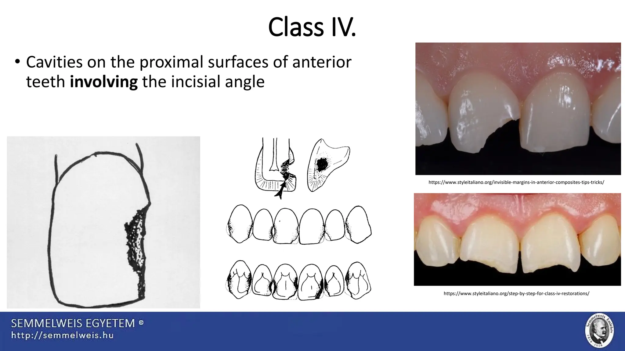 Blacks cavity classification for pit and fissure caries.pdf