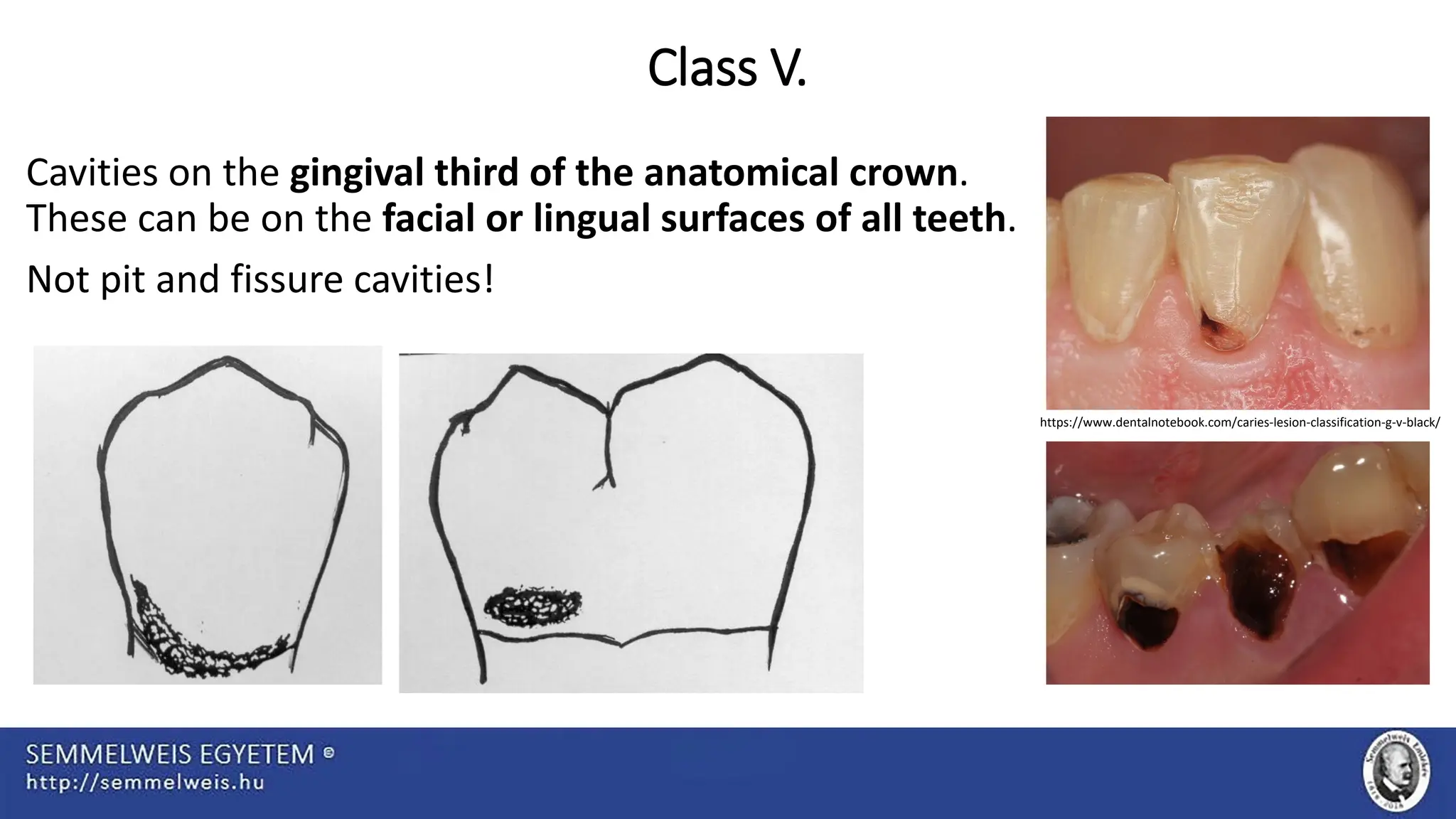 Blacks cavity classification for pit and fissure caries.pdf