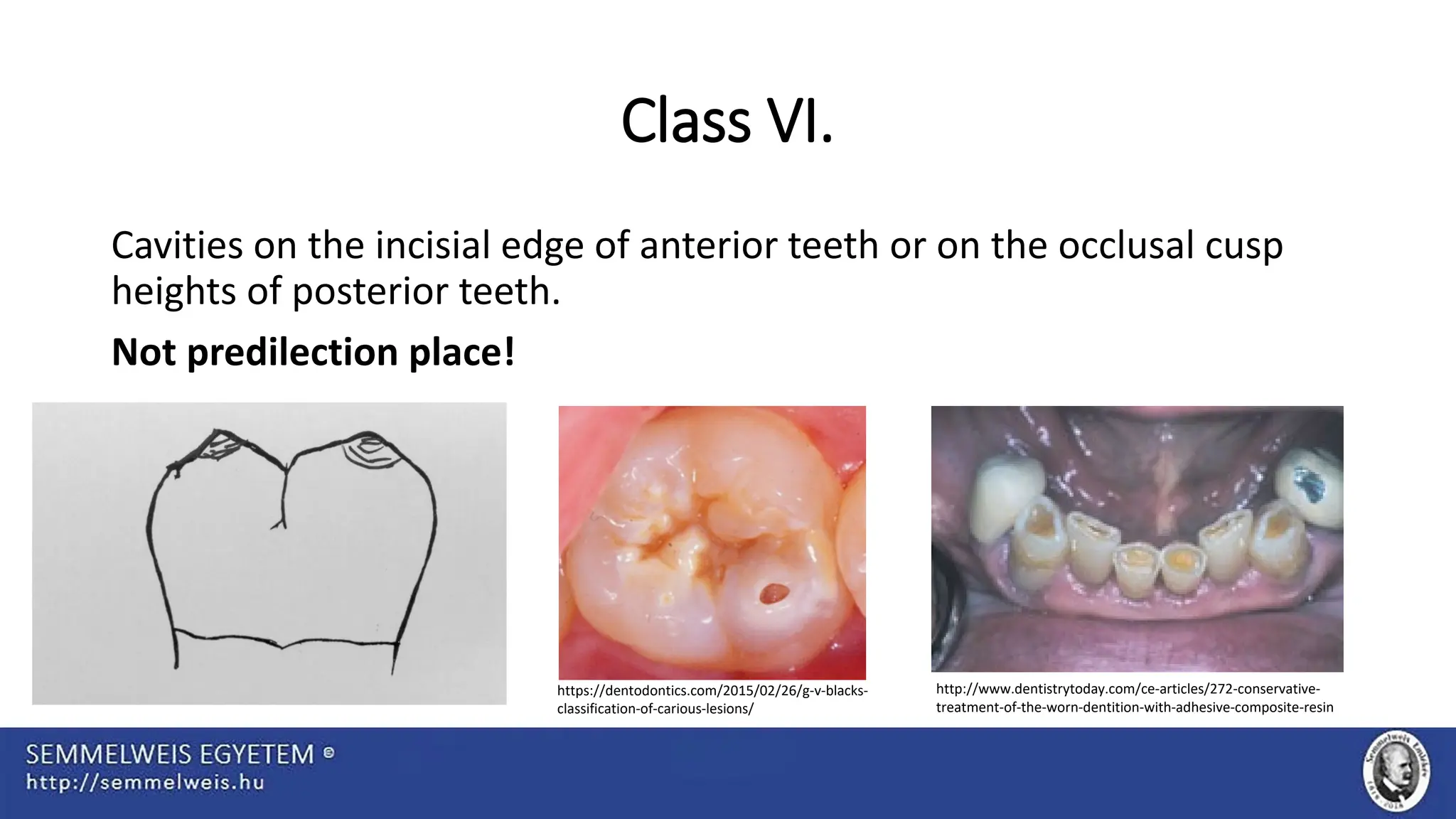 Blacks cavity classification for pit and fissure caries.pdf