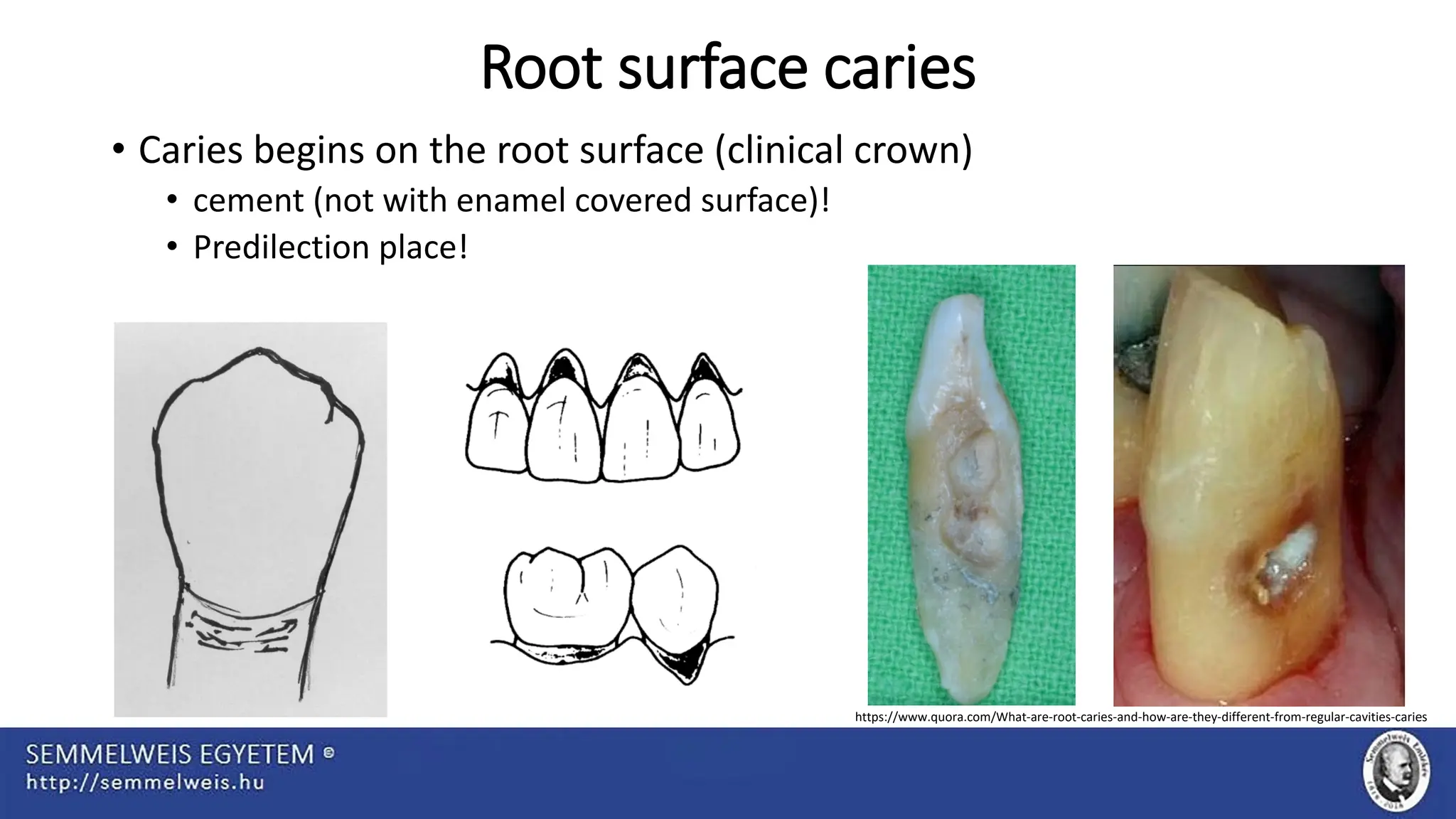 Blacks cavity classification for pit and fissure caries.pdf