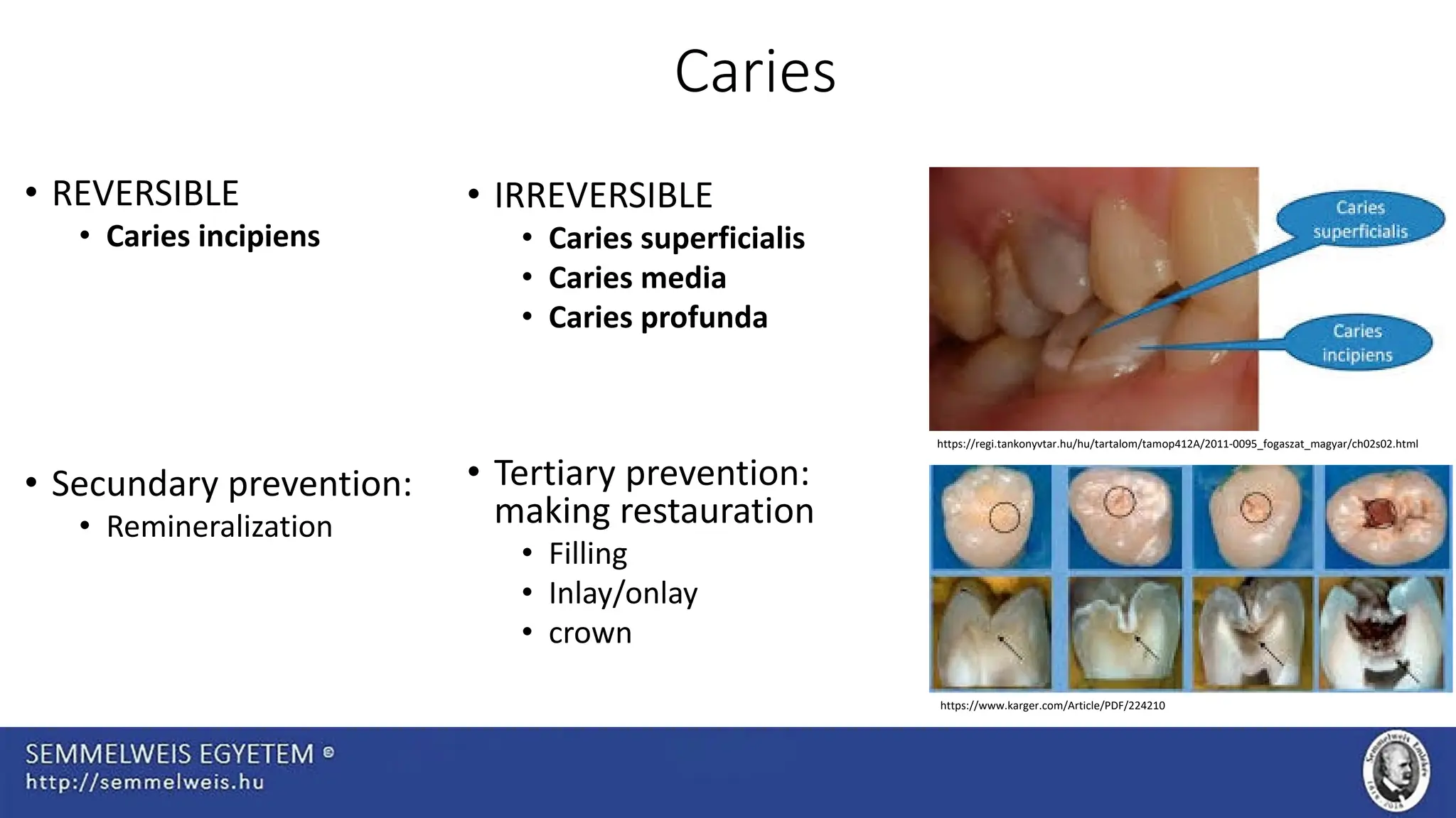Blacks cavity classification for pit and fissure caries.pdf