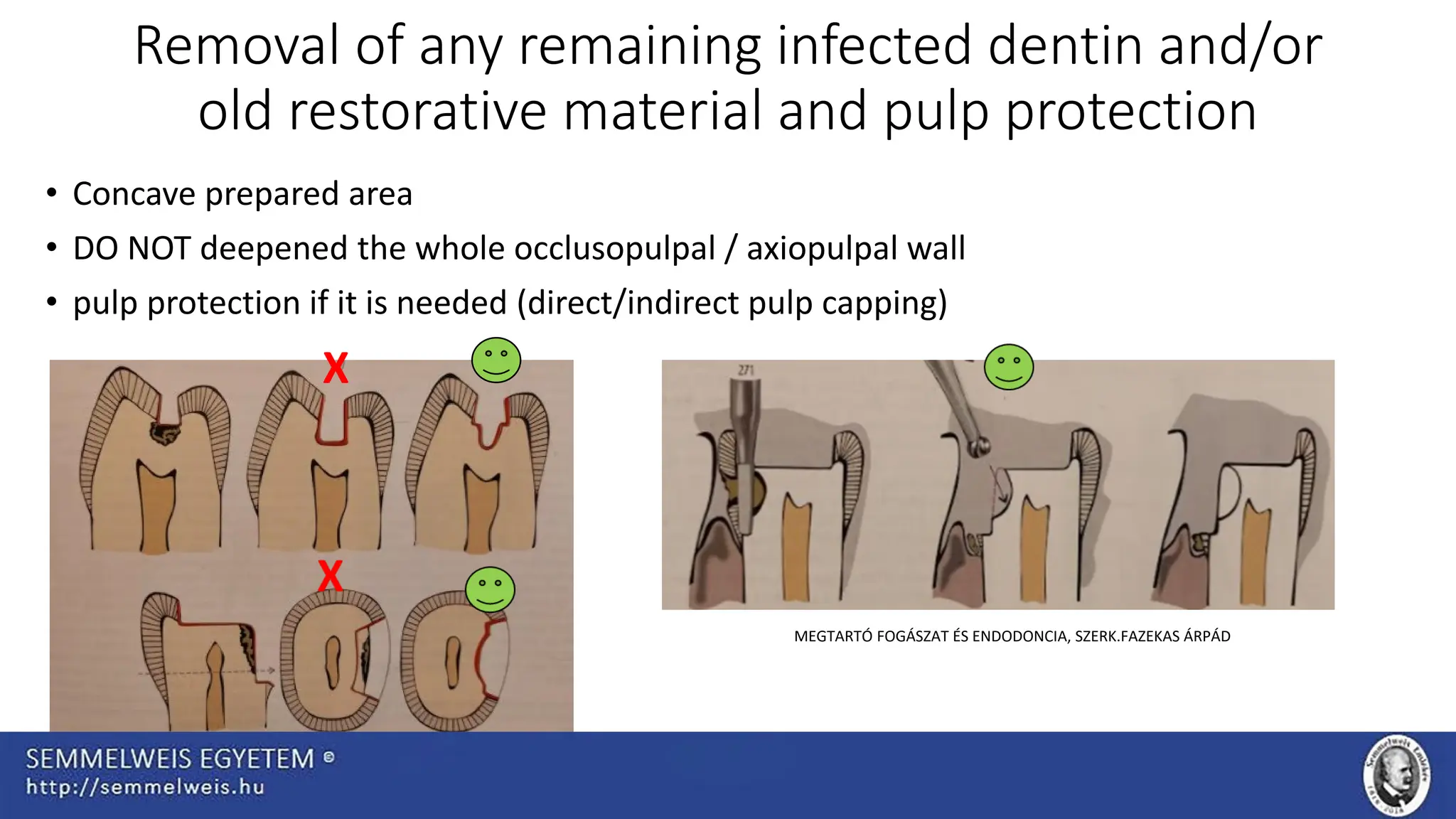 Blacks cavity classification for pit and fissure caries.pdf