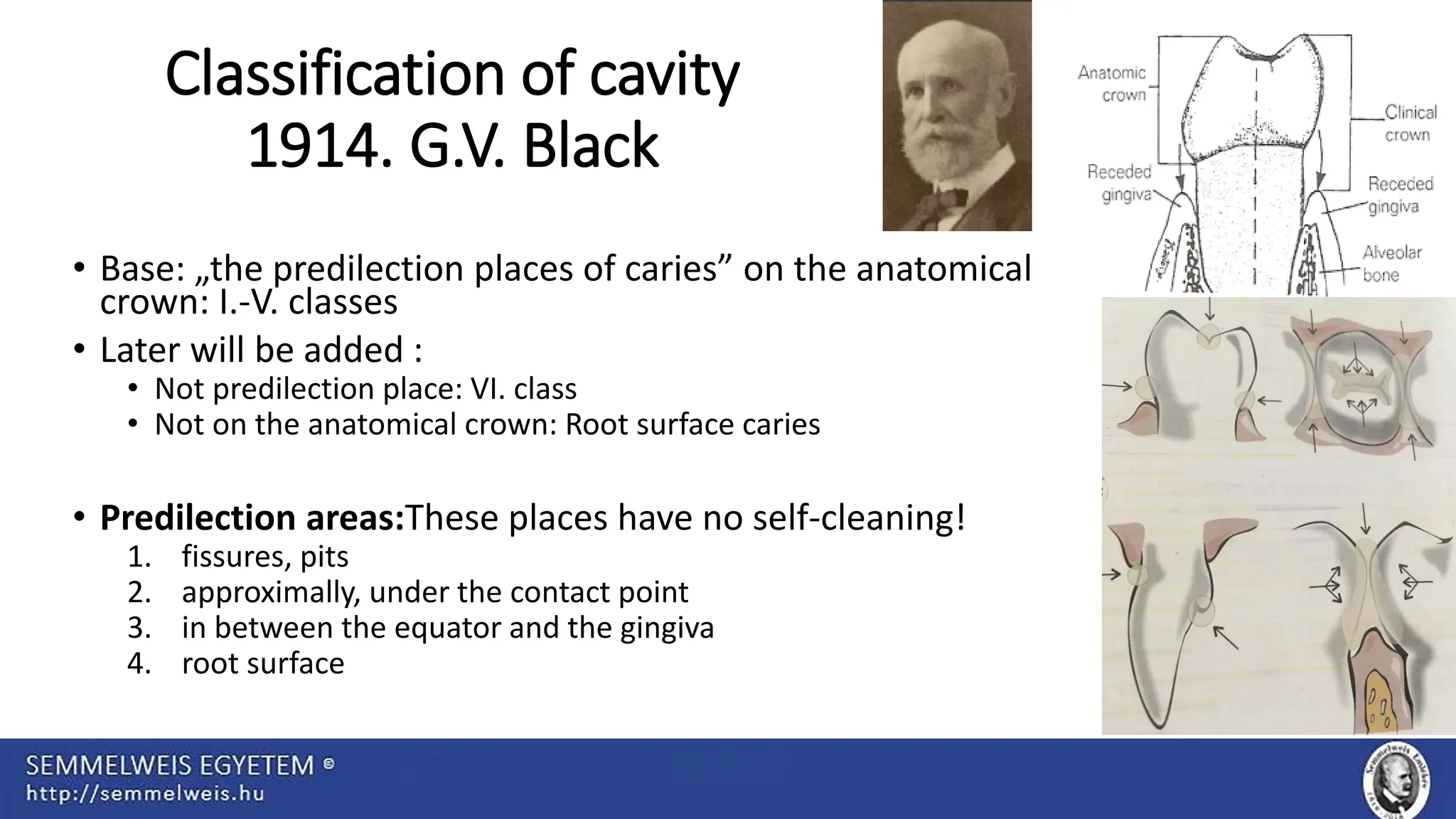 Blacks cavity classification for pit and fissure caries.pdf