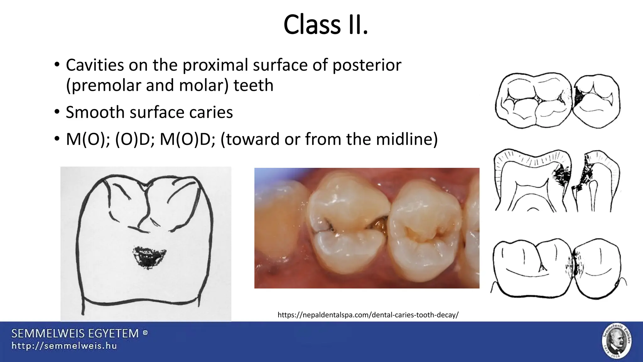 Blacks cavity classification for pit and fissure caries.pdf