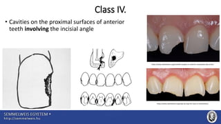 Blacks cavity classification for pit and fissure caries.pdf