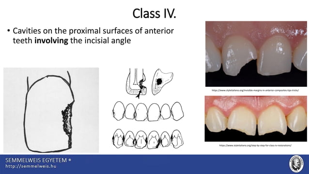 Blacks cavity classification for pit and fissure caries.pdf