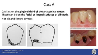 Blacks cavity classification for pit and fissure caries.pdf