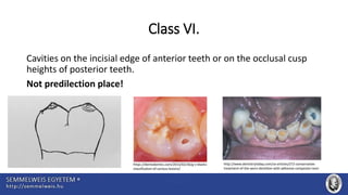 Blacks cavity classification for pit and fissure caries.pdf