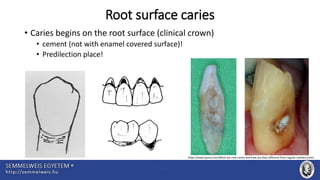 Blacks cavity classification for pit and fissure caries.pdf