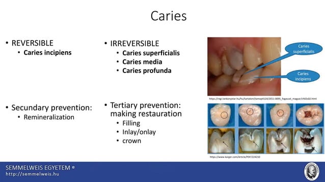 Blacks cavity classification for pit and fissure caries.pdf