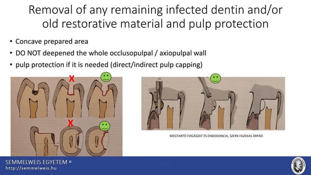 Blacks cavity classification for pit and fissure caries.pdf