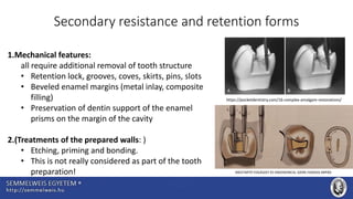 Blacks cavity classification for pit and fissure caries.pdf