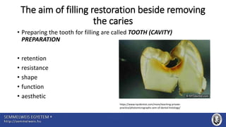 Blacks cavity classification for pit and fissure caries.pdf