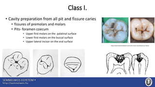 Blacks cavity classification for pit and fissure caries.pdf