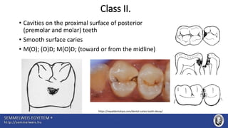 Blacks cavity classification for pit and fissure caries.pdf