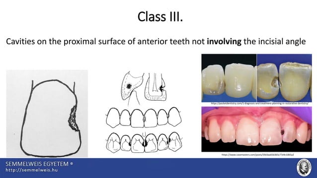 Blacks cavity classification for pit and fissure caries.pdf