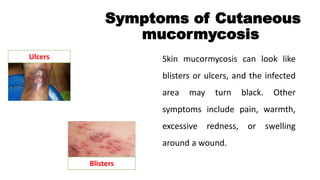 Black fungus #mucormycosis #cutaneous (skin) mucormycosis # ...