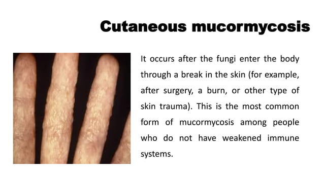 Black fungus #mucormycosis #cutaneous (skin) mucormycosis # ...