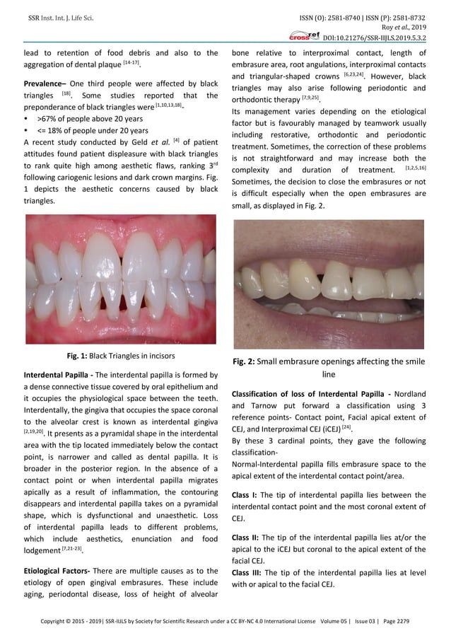 Black_Triangles_and_its_Management.pdf | Dental Health | Diseases and ...