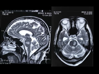 Bladder - UMN Versus LMN bladder | PPTX