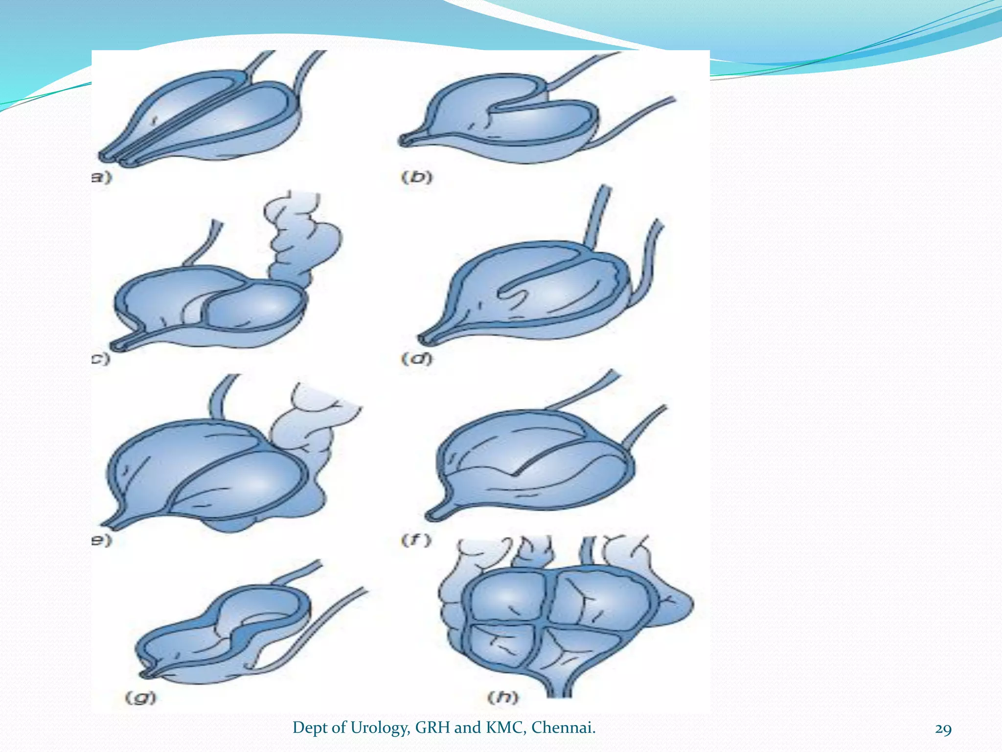 Urinary Bladder anomalies congenital | PDF