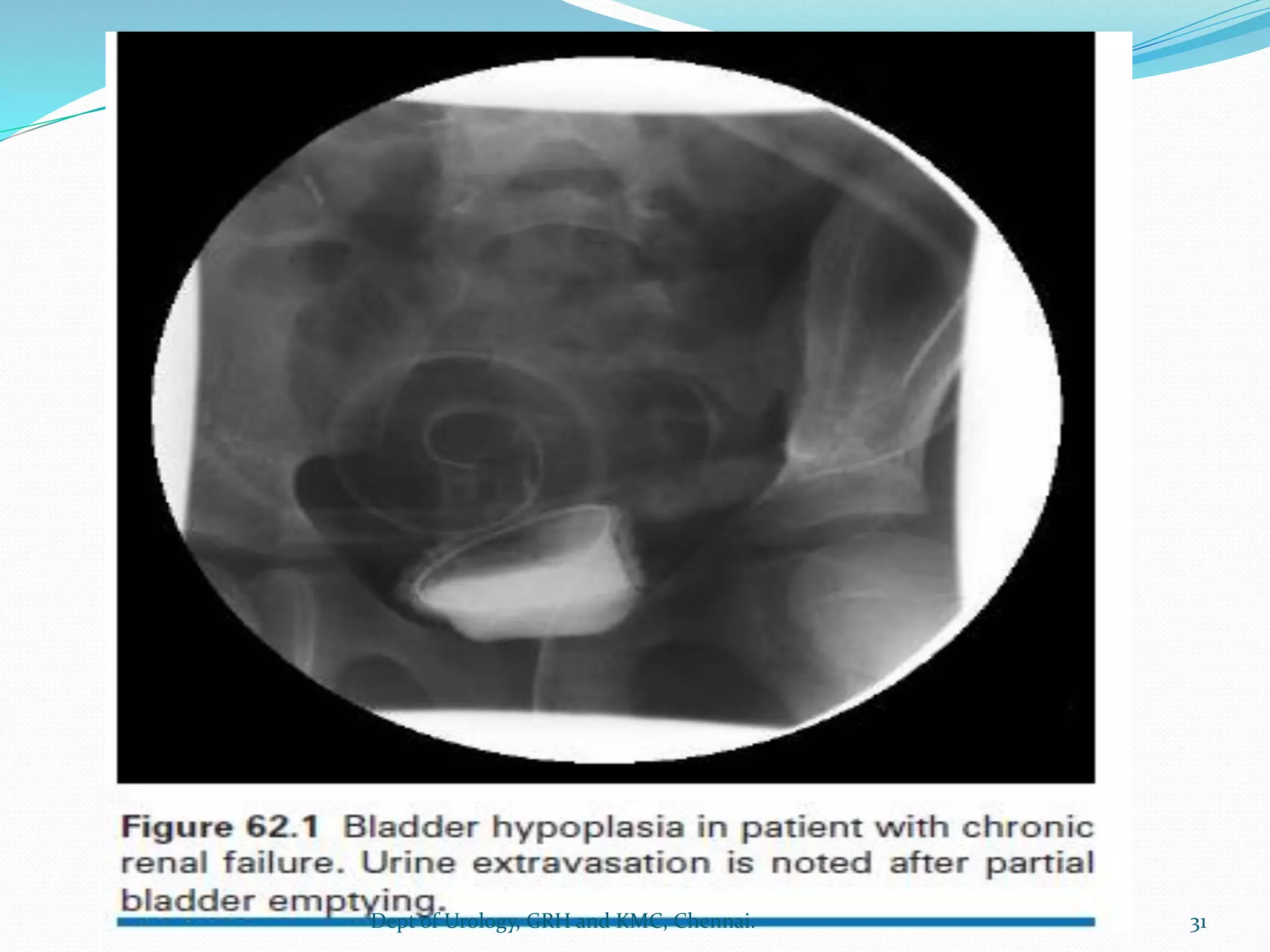 Urinary Bladder anomalies congenital | PDF