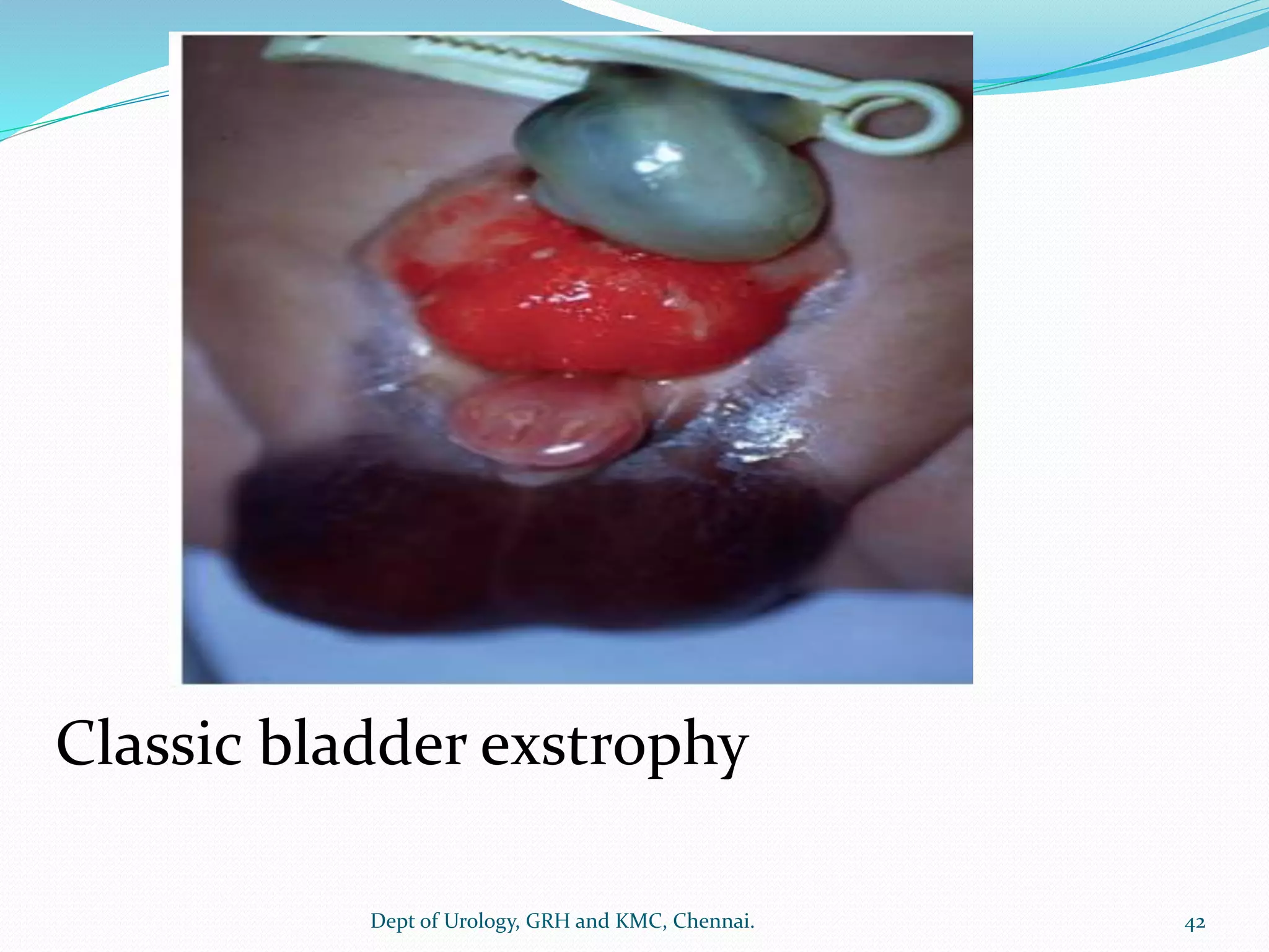 Urinary Bladder anomalies congenital | PDF