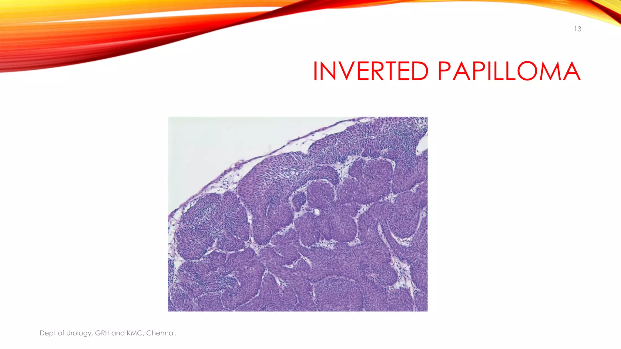 Benign Urinary Bladder Tumors | PDF